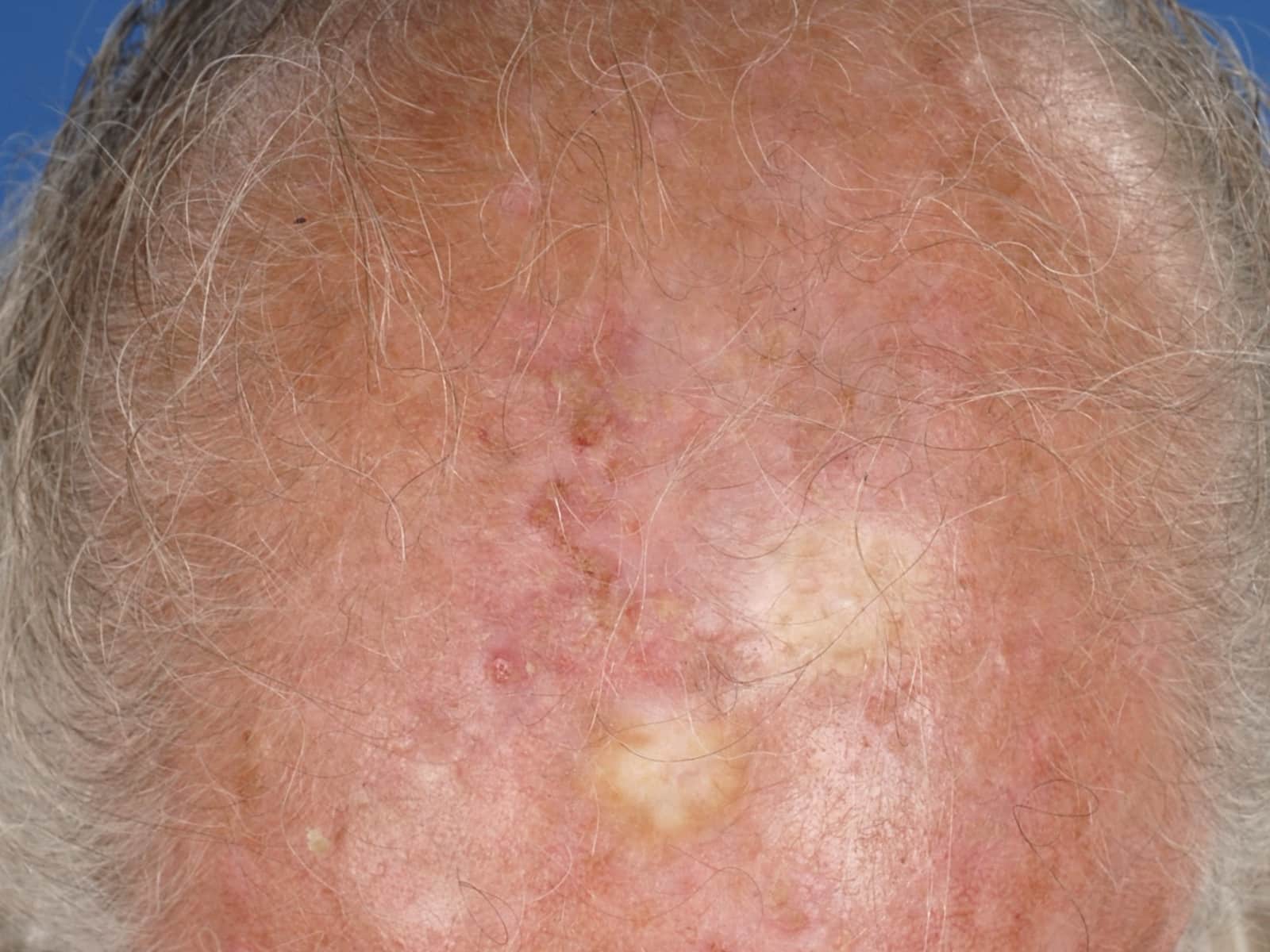 Actinische keratose - Kliniek Ebbelaar